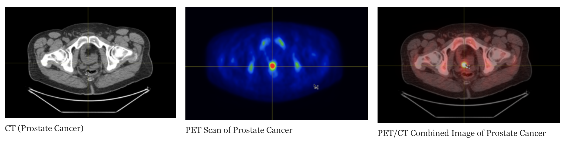 PET Scanning For Prostate Cancer | PET Imaging Institute